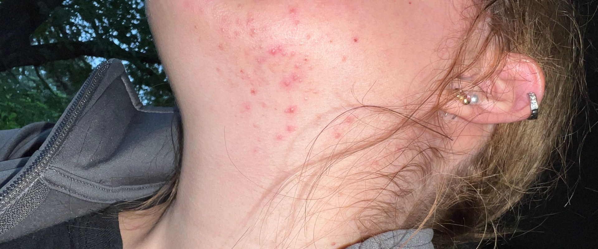 Why Dermaplaning Can Lead to Breakouts